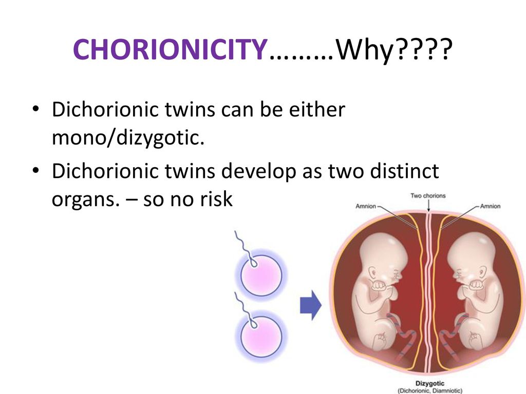 Monoamniotic Dichorionic Twins